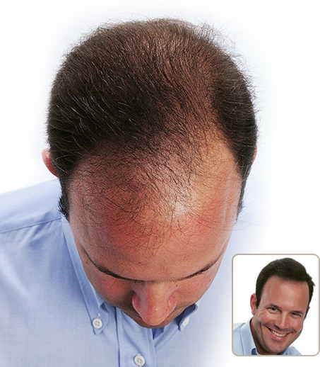 DermMatch Hair Loss Concealer - #1 For Thinning Hair, Bald Areas - For ...